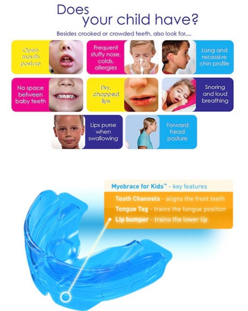 Myobrace for Kids: Understanding the Benefits for Dental Development